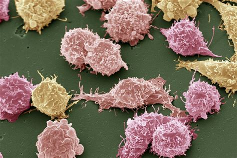 Cancro Ovarico Ecco Come Si Diffondono Le Metastasi
