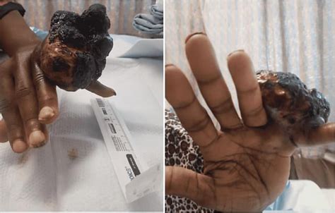 Pleomorphic Sarcoma Of The Hand Rmedicalgore