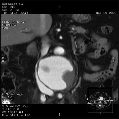Inflammatory Infrarenal Aortic Aneurysm With Aortocaval Fistula