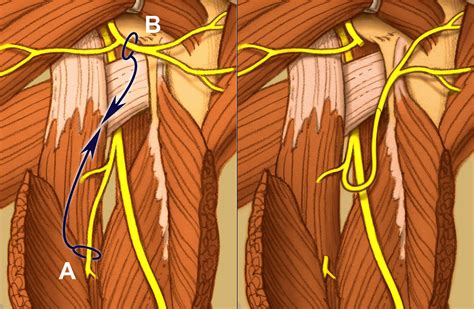Factors Affecting Outcome Of Triceps Motor Branch Transfer For Isolated