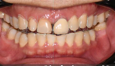 Rapid Sequence Cementation Absolute Isolation