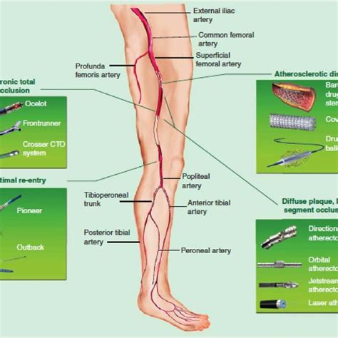 Prognostic Impact Of Diabetes Mellitus And Dialysis A Cumulative