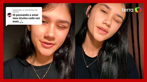 Jovem perde a visão de um olho pelo mau uso de lentes de contato relato viralizou