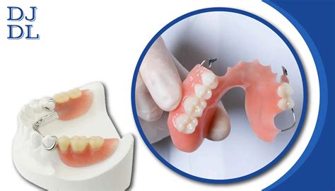 What Are Removable Dentures Dave Johnson Dental Lab