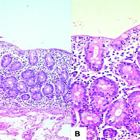Histology Of Representative Cases A Duodenal Biopsy Showing Total