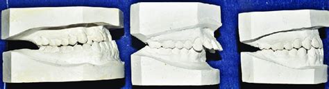 Angles Class I Ii And Iii Right To Left Sagittal Dental