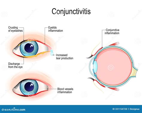 Conjunctivitis Pink Eye Stock Illustration Illustration Of Bacterial