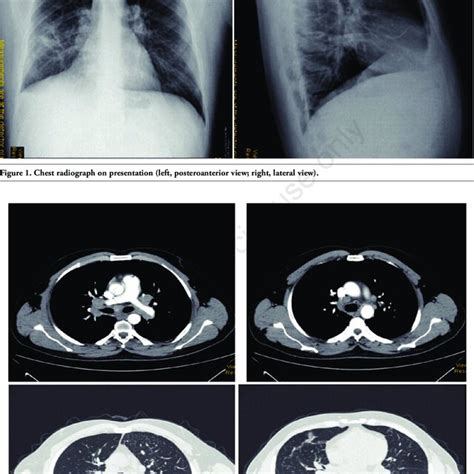 Chest Ct Showing Mediastinal Lymph Nodes Bilaterally Interlobular