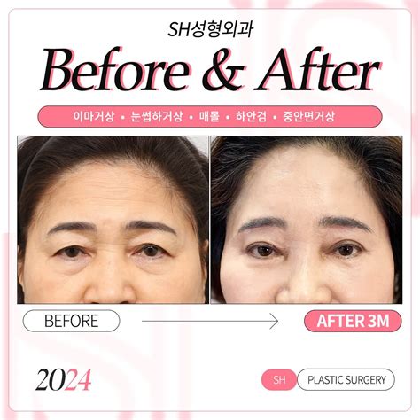 에스에이치성형외과의원 자연스러움의 끝판왕 Sh 눈썹하거상술 찐 리얼 후기 🏻 기존 쌍꺼풀 라인과 눈매는 유지하되 더