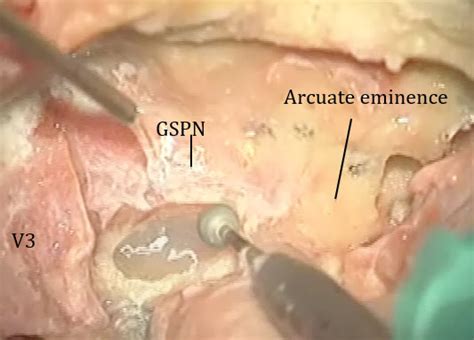 Cavernous Sinus 3d Atlas Of Neurological Surgery