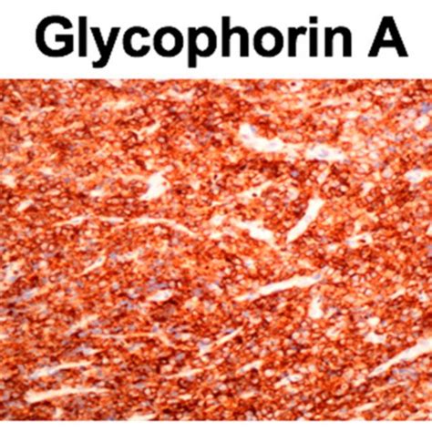 Periorbital Biopsy Diffuse Infiltrate Of Medium Sized Cells With