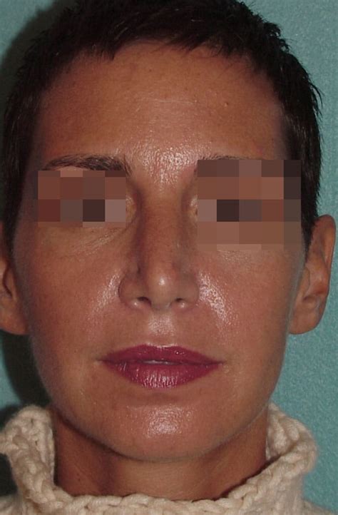 Revision Rhinoplasty 17 Robert A Guida Md Pc