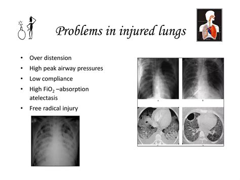 Ventilatory Strategies In Ards Pdf