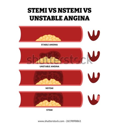 2 Resultados De Imágenes Fotos De Stock E Ilustraciones Libres De Regalías Para Nstemi Vs Stemi