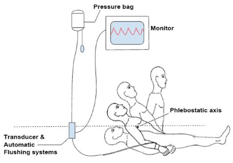 Critical Care Device Series Arterial Lines Part 2 Waveforms And Damping Emra
