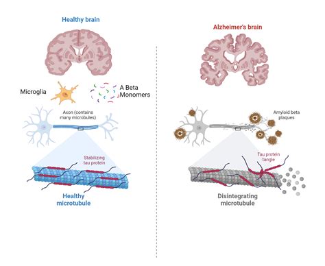 Pathology Of Alzheimers Disease 2 Biorender Science Templates