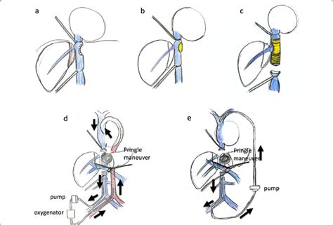For Reconstruction Of The Suprahepatic Ivc And Rhv With An Artificial