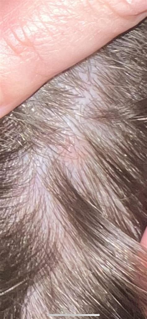 Lump On My Scalp Anyone Have Any Ideas R Dermatologyquestions