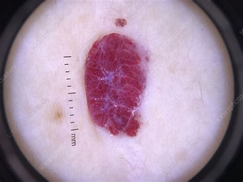 Angioma Dermoscopy Stock Image C0563107 Science Photo Library