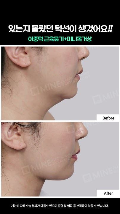 둔둔한 얼굴을 더 갸름하게 만들어주는 V라인 턱선 😎 이중턱근육묶기 미니목거상 미니목 이중턱 턱살 턱선 이중턱지방흡입 이중턱수술 이중턱리프팅 마인성형외과