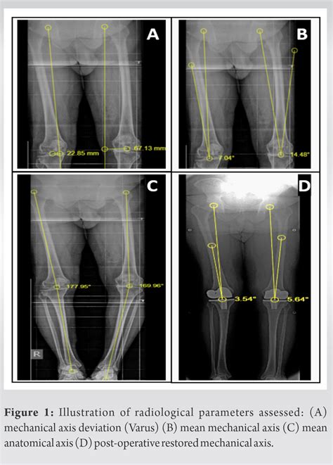 Functional And Radiological Outcome Of Simultaneous Bilateral Total