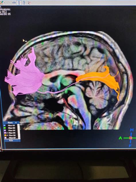 Umar Mushtaq On Linkedin Dti Fibretracking Brainimaging Brainneuro