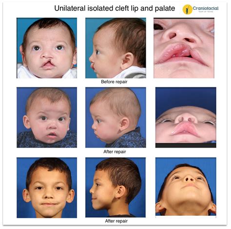 Cleft Lip And Palate Chart