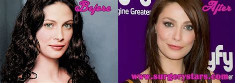 Joanne Kelly Lips Before After