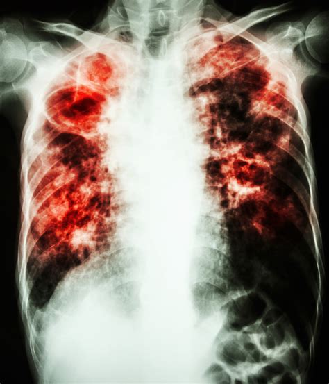 Sarcoidosis Symptoms Are Wide Ranging And Depend On The Areas Affected