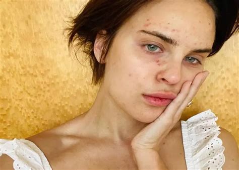 Tallulah Willis ने स्किन पिकिंग डिसऑर्डर से अपने संघर्ष के बारे में