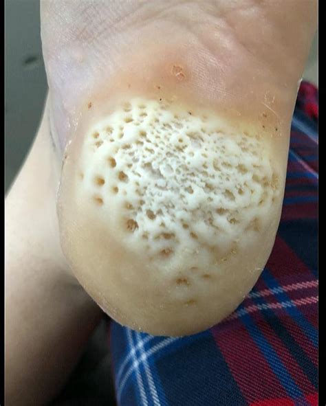 Pitted Keratolysis Shoes At Maria Baum Blog
