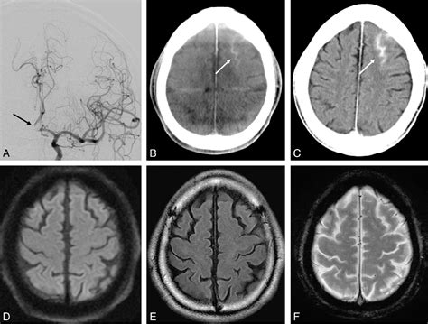 Figure 1 From Subarachnoid Hyperattenuation On Flat Panel Detector