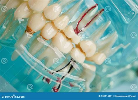 Dental Implant Artificial Tooth Roots Into Jaw Root Canal Of Dental