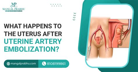 What Happens To The Uterus After Uterine Artery Embolization