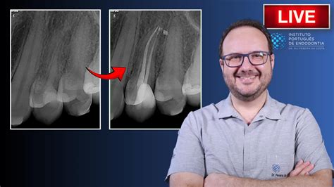 Tx Of 🦷24 With Symptomatic Irreversible Pulpitis ️ Single Session