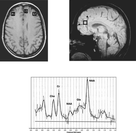 Anatomic Image Of The Left 1 And Right 2 Dlpfc And Left Anterior Download Scientific