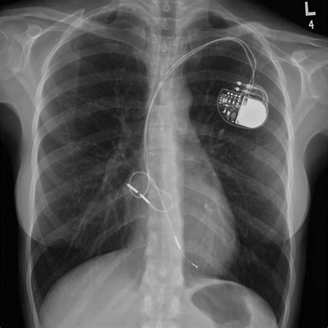 Contrast Enhanced Cardiac Computed Tomography Of The Heart Volume