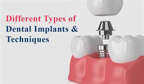 Dental Implants Types Of Implants And Who They Re For Peak Mens Health