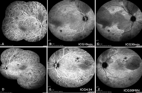 Indocyanine Green Angiography Icga Revealed Hypofluorescent Spots Of