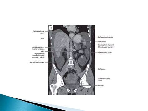 Imaging Anatomy Of Peritoneum Pptx