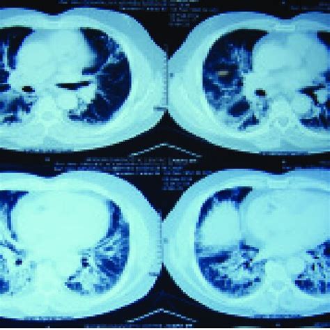 Hrct Depicting Diffuse Areas Of Pulmonary Infiltration A Bilateral