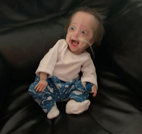 La inspiradora historia del bebé que nació con el síndrome de Benjamin Button Es un niño con