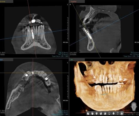 디지털 임플란트 편한미소치과