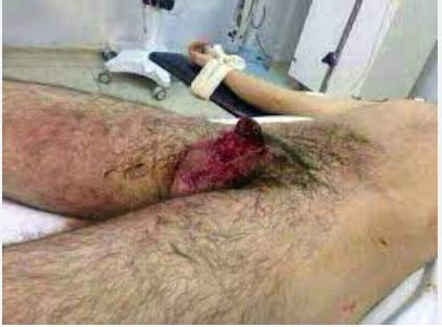 Mulher descobre traição corta o pênis do marido tira foto e joga na