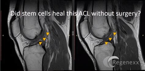 Acl Mri Evidence For The Perc Aclr Centeno Schultz Clinic