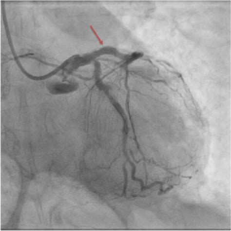12 Lead Ecg Showing St Elevations In Anterior Leads Download Scientific Diagram
