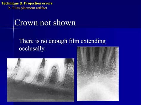 Radiographic Errors And Artifacts Pptx