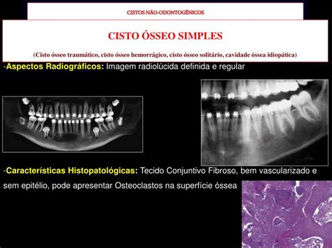 PPT CISTOS Odontogênicos e Não Odontogênicos PowerPoint