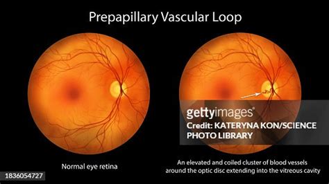 Prepapillary Vascular Loop On The Retina Illustration High Res Vector