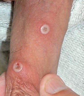 File Monkeypox Lesions Wikimedia Commons